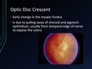 Choroidal Crescent Vs Scleral Crescent