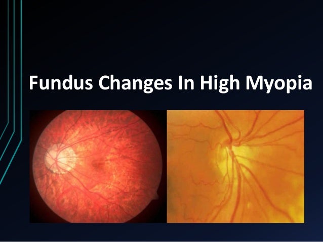 High myopia and management
