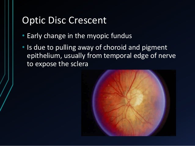 High myopia and management