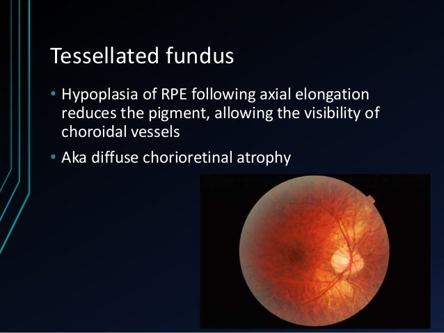 High myopia and management