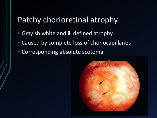 High myopia and management