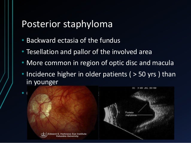 High myopia and management