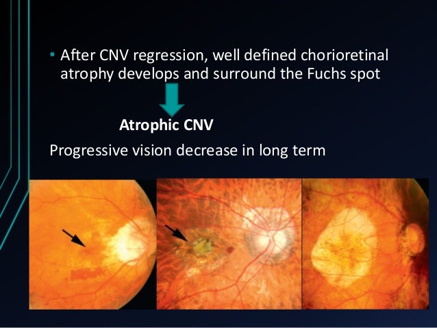 High myopia and management