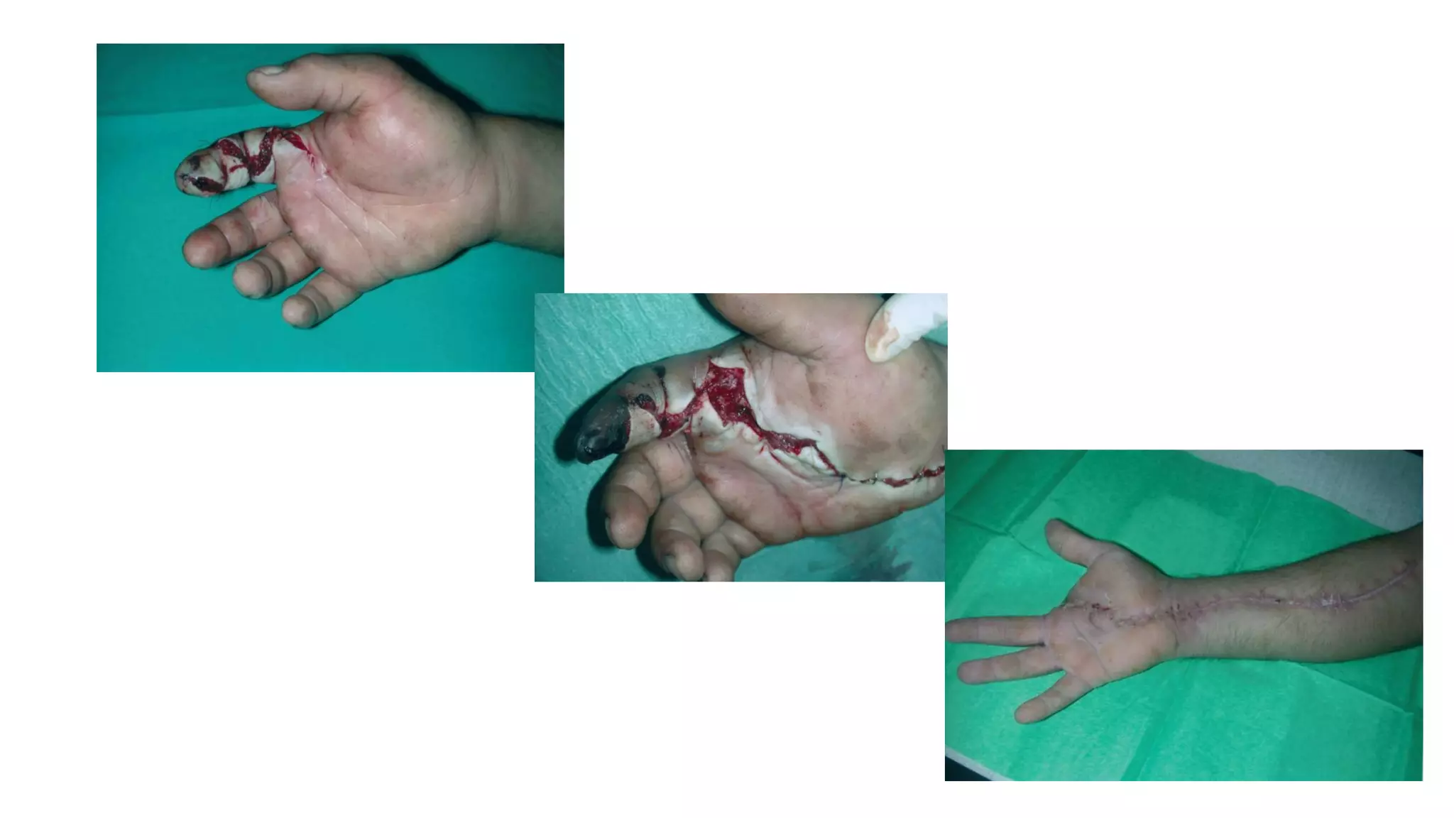 High pressure injection injuries Dr Sean Nicklin | PDF