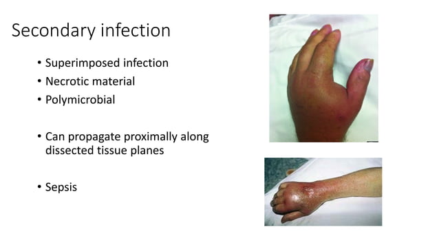 High pressure injection injuries Dr Sean Nicklin | PDF | First Aid ...