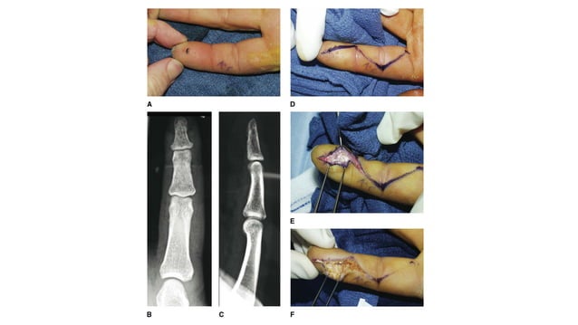 High pressure injection injuries Dr Sean Nicklin | PDF | First Aid ...
