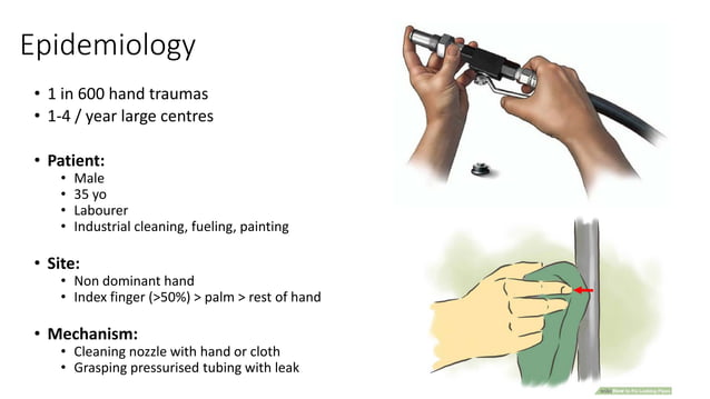 High pressure injection injuries Dr Sean Nicklin | PDF | First Aid ...
