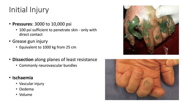High pressure injection injuries Dr Sean Nicklin | PDF | First Aid ...