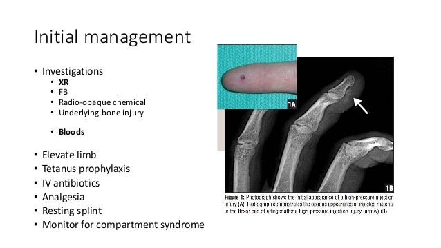 High pressure injection injuries Dr Sean Nicklin