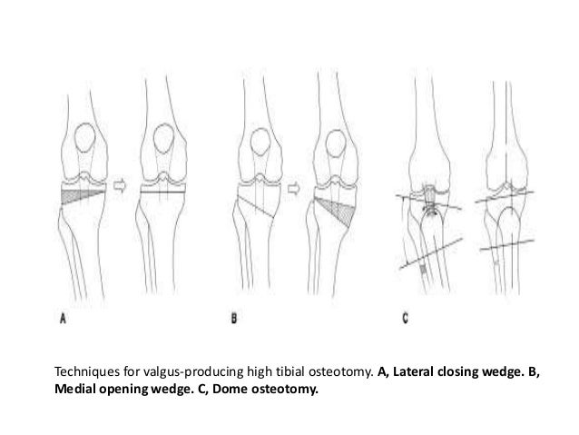 High tibial osteotomy