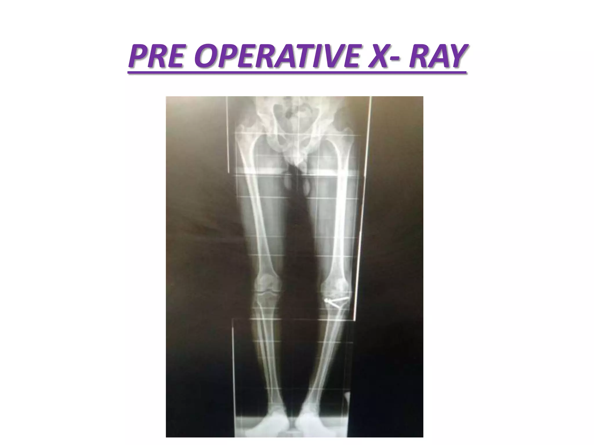 High tibial osteotomy in osteoarthritis knee & genu varum | PPT
