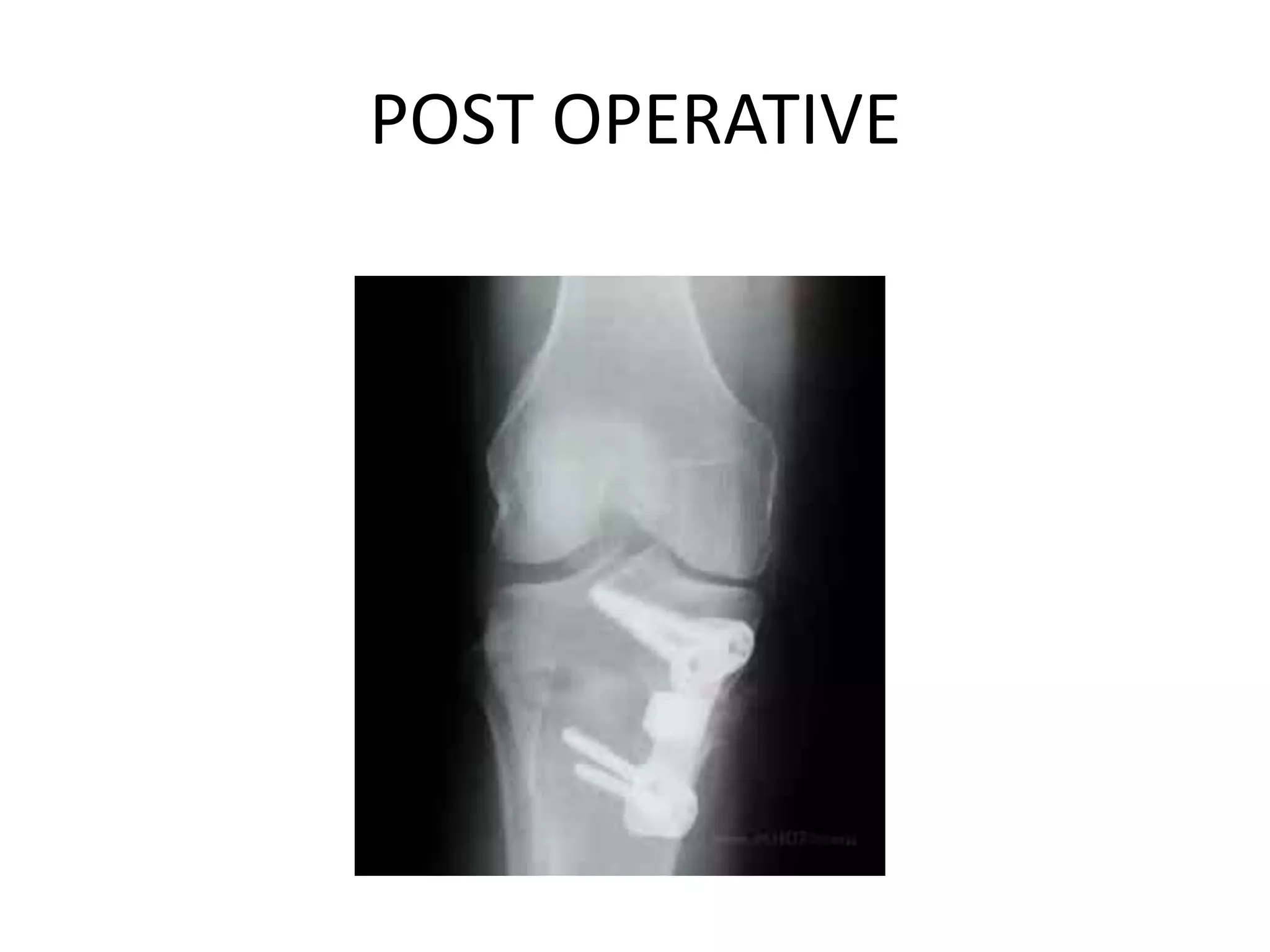 High tibial osteotomy in osteoarthritis knee & genu varum | PPT