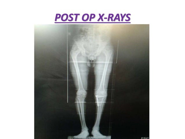 High tibial osteotomy in osteoarthritis knee & genu varum | PPT