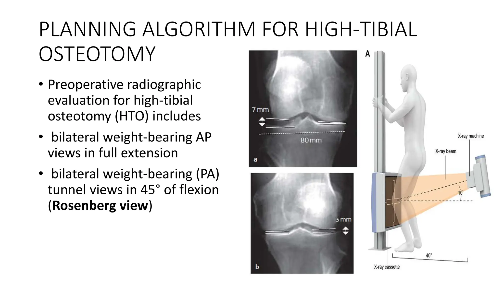 HIGH TIBIAL OSTEOTOMY AROUND THE KNEE.pptx