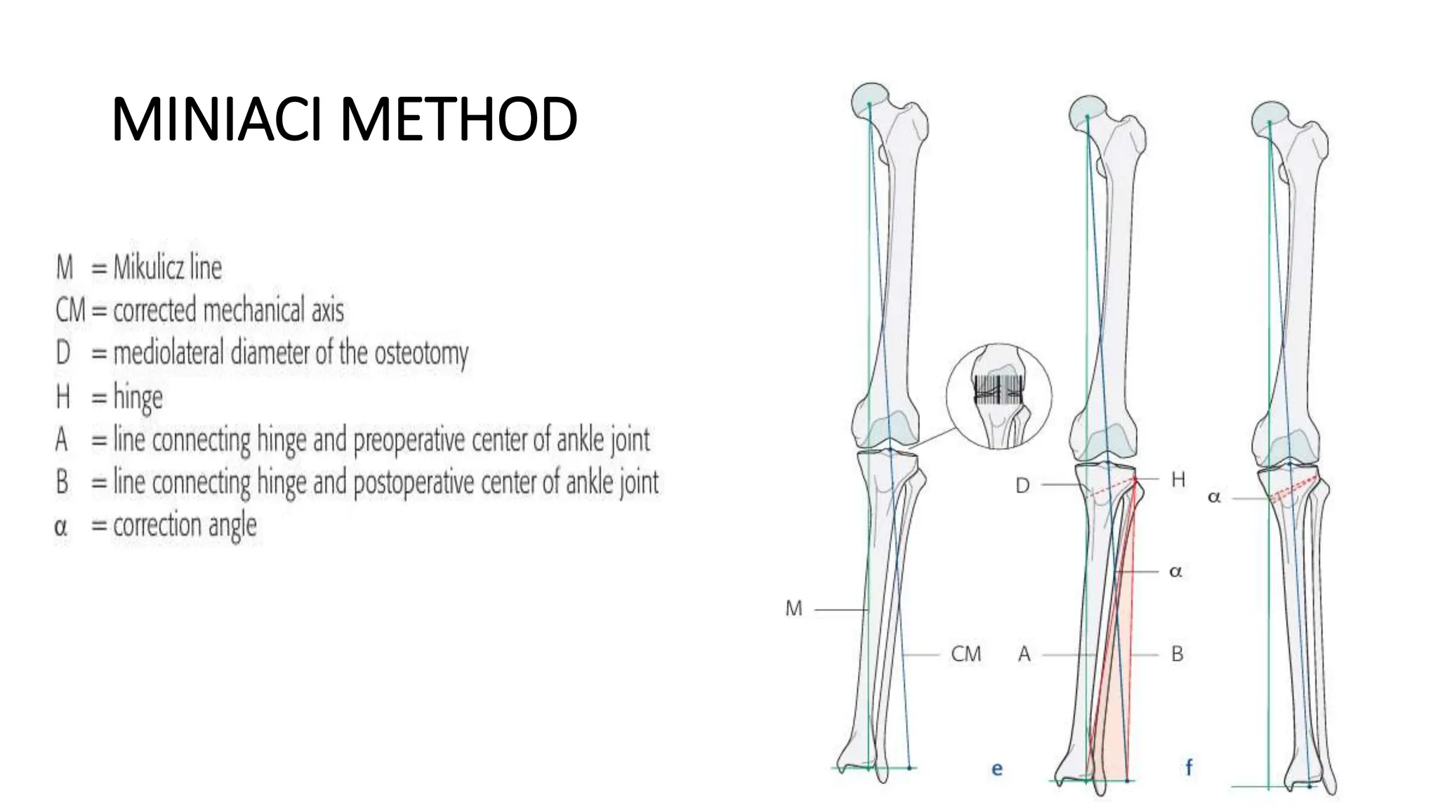 HIGH TIBIAL OSTEOTOMY AROUND THE KNEE.pptx