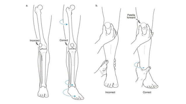 HIGH TIBIAL OSTEOTOMY AROUND THE KNEE.pptx | Death, Injury, or Military ...
