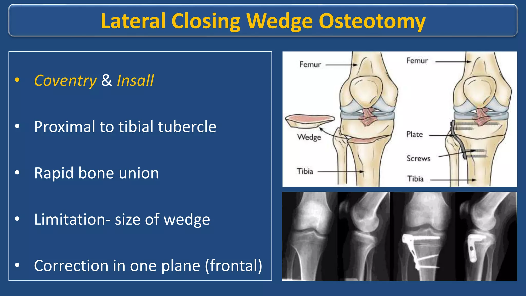 High tibial osteotomy | PPTX
