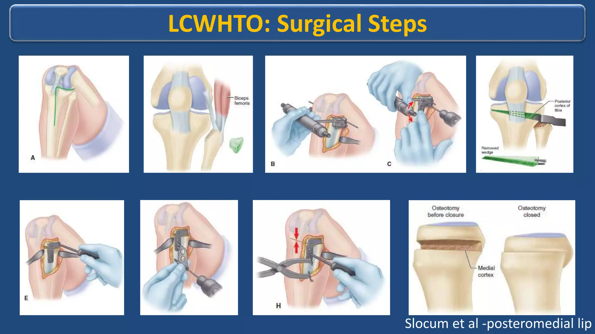 High tibial osteotomy | PPTX