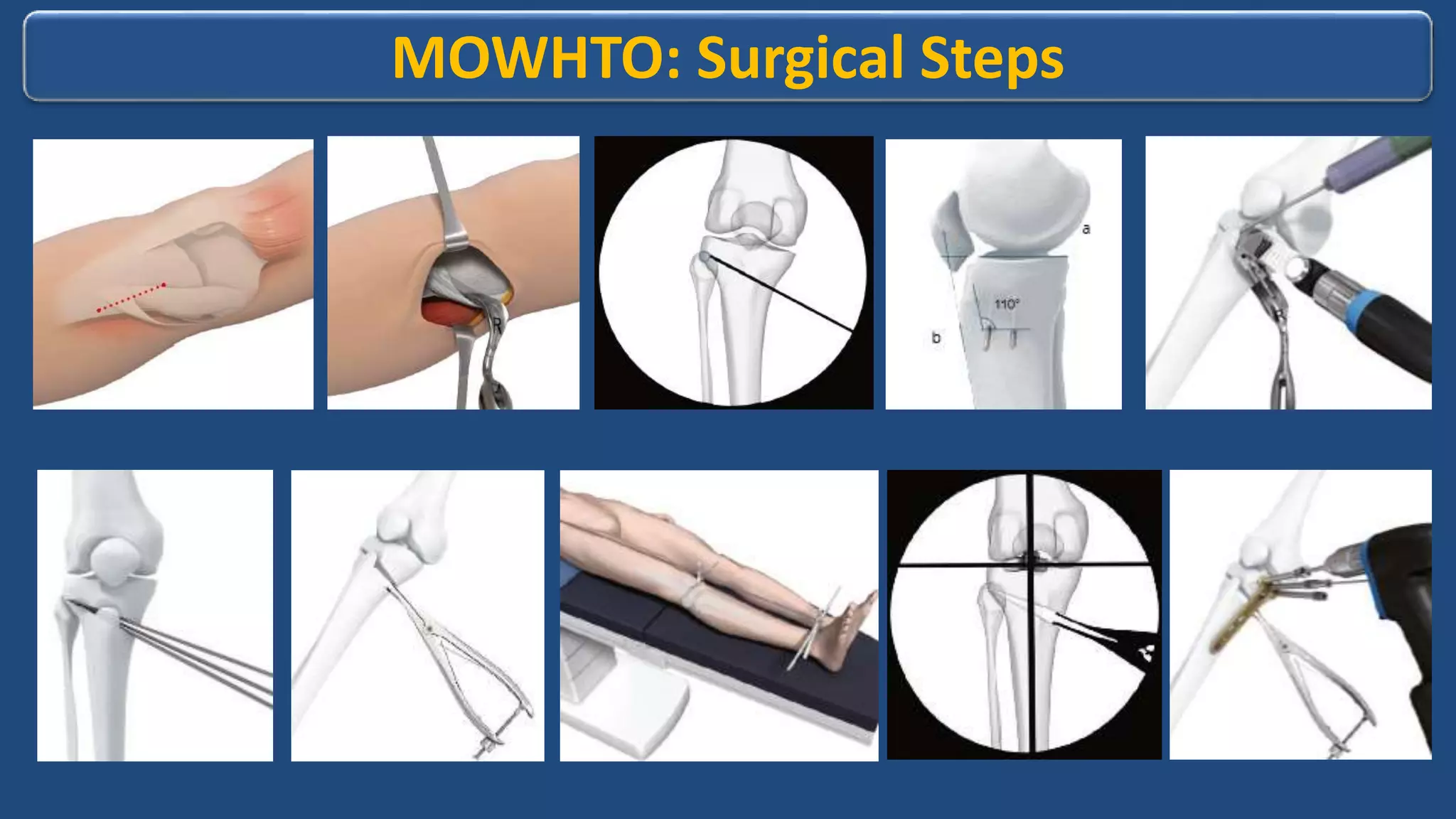 High tibial osteotomy | PPTX