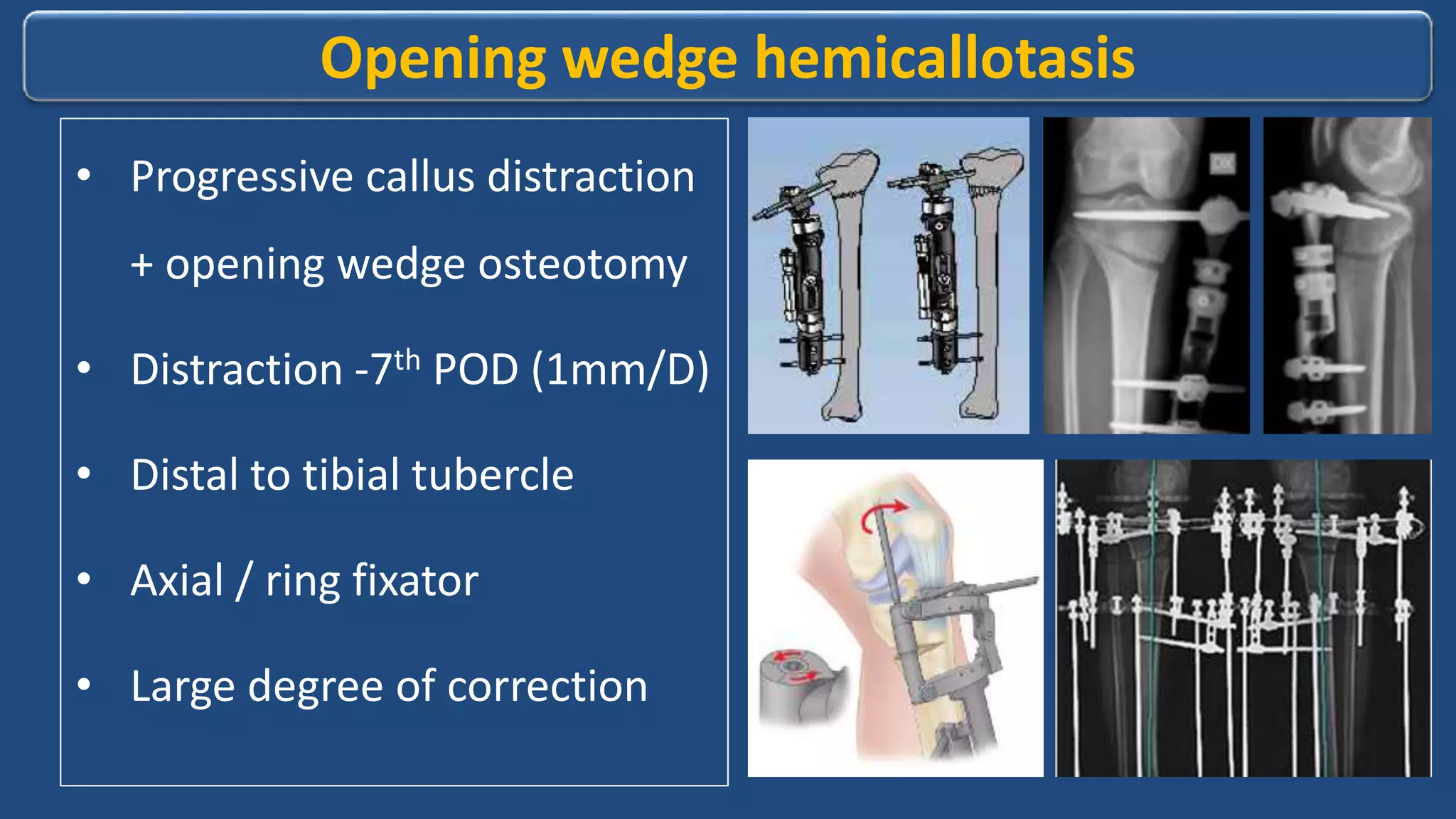 High tibial osteotomy | PPTX