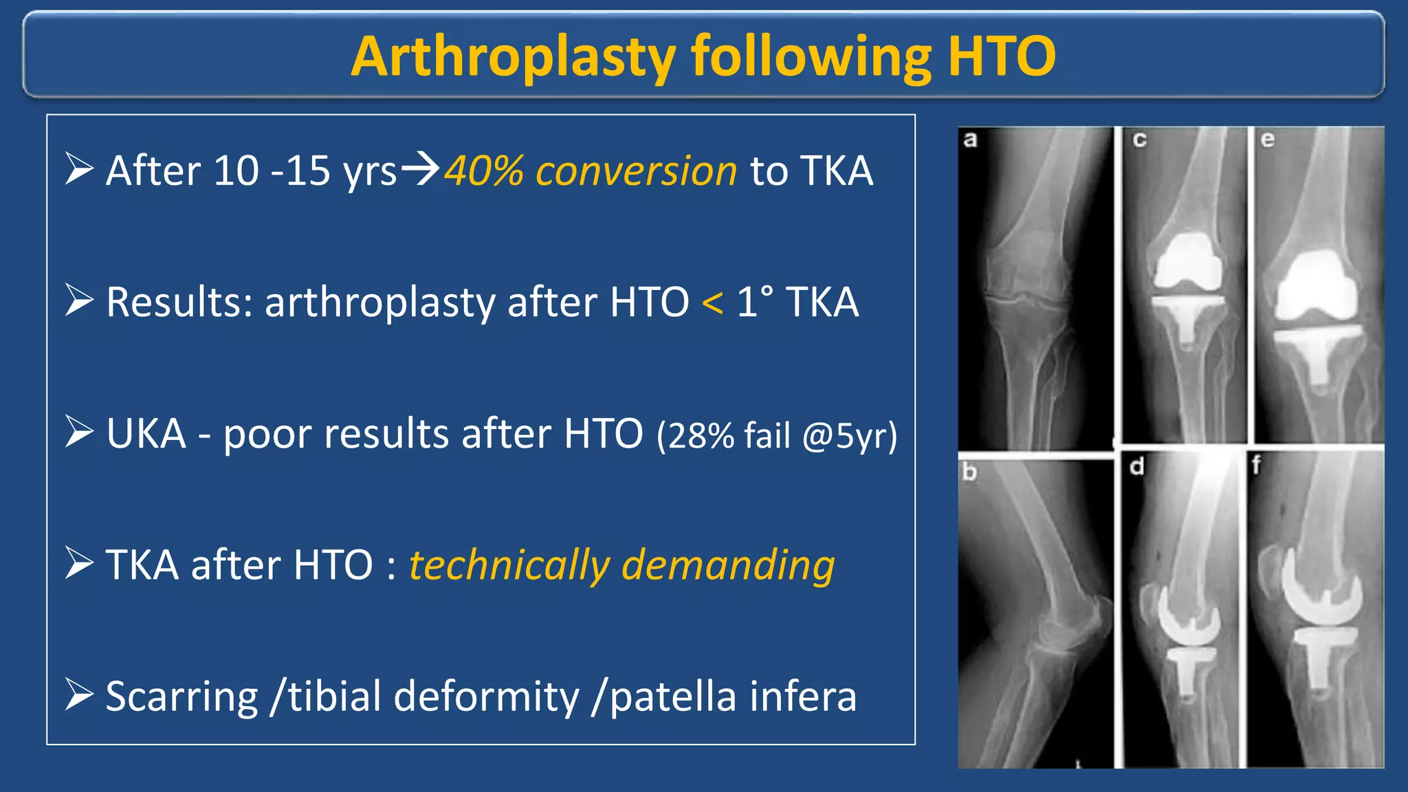 High tibial osteotomy | PPTX