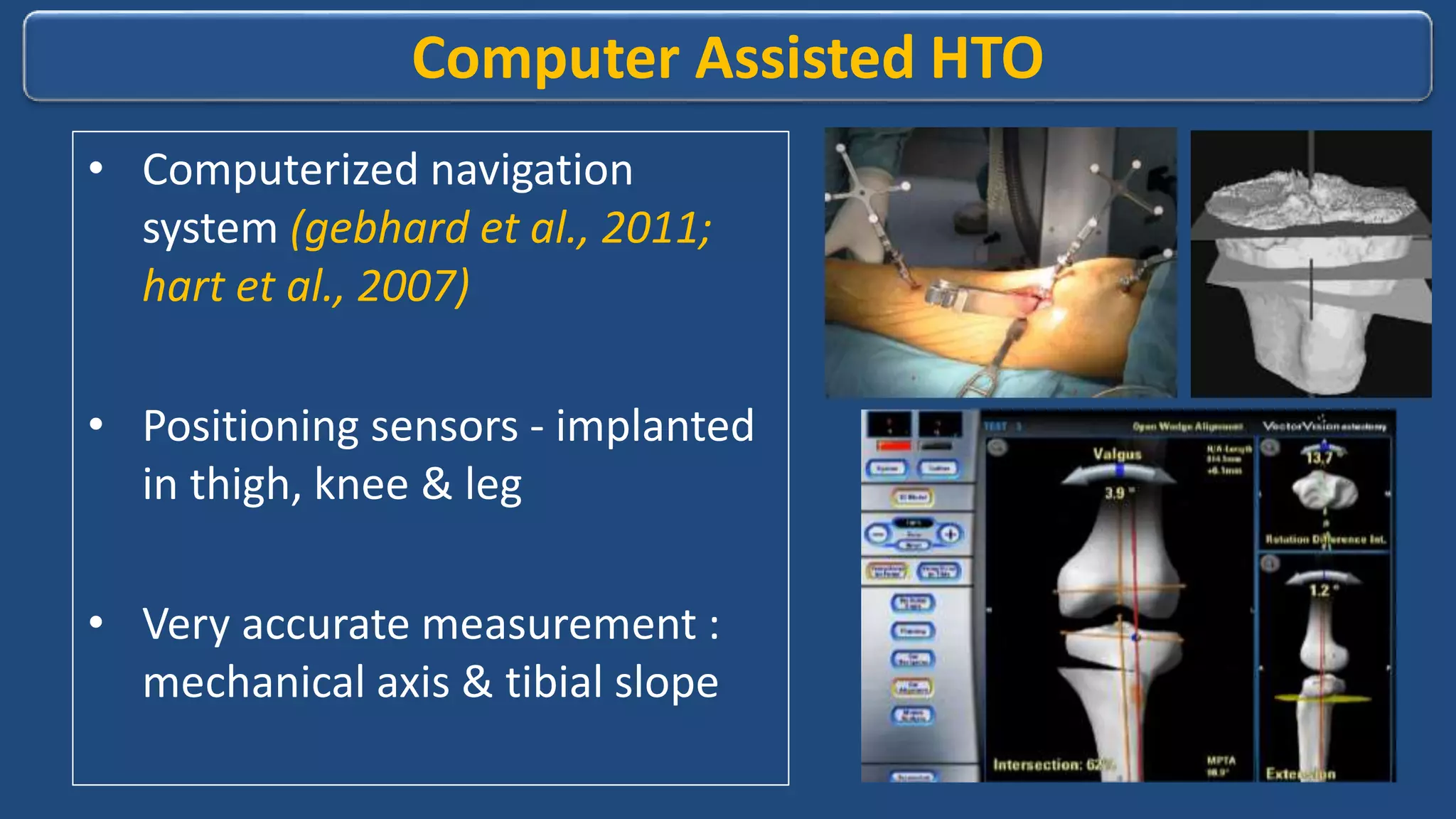 High tibial osteotomy | PPTX