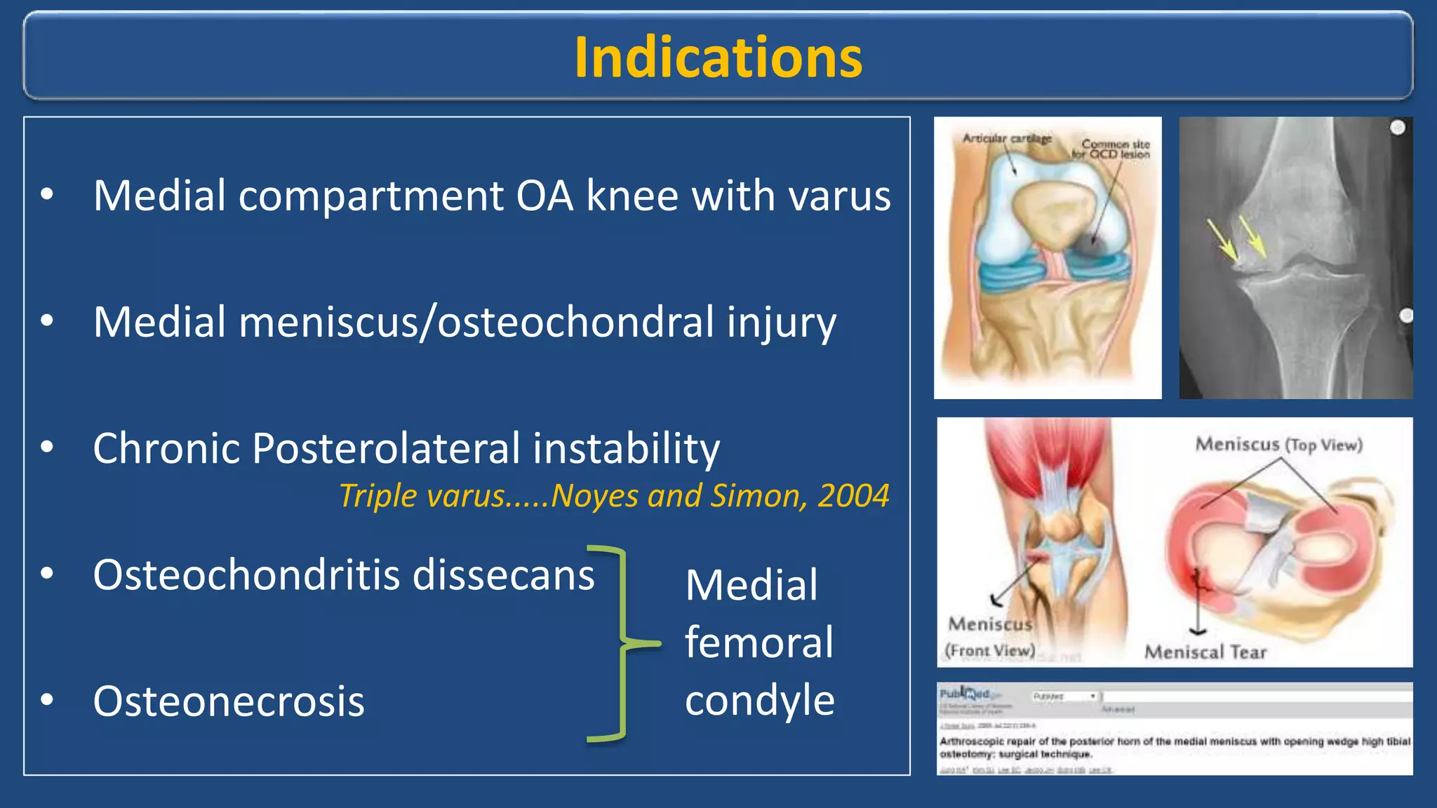 High tibial osteotomy | PPTX