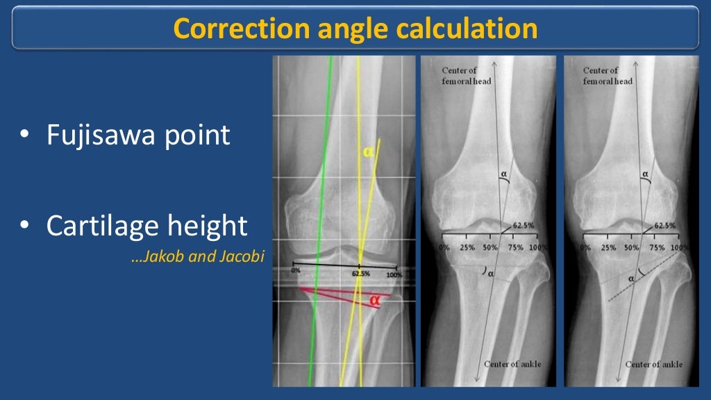 High tibial osteotomy