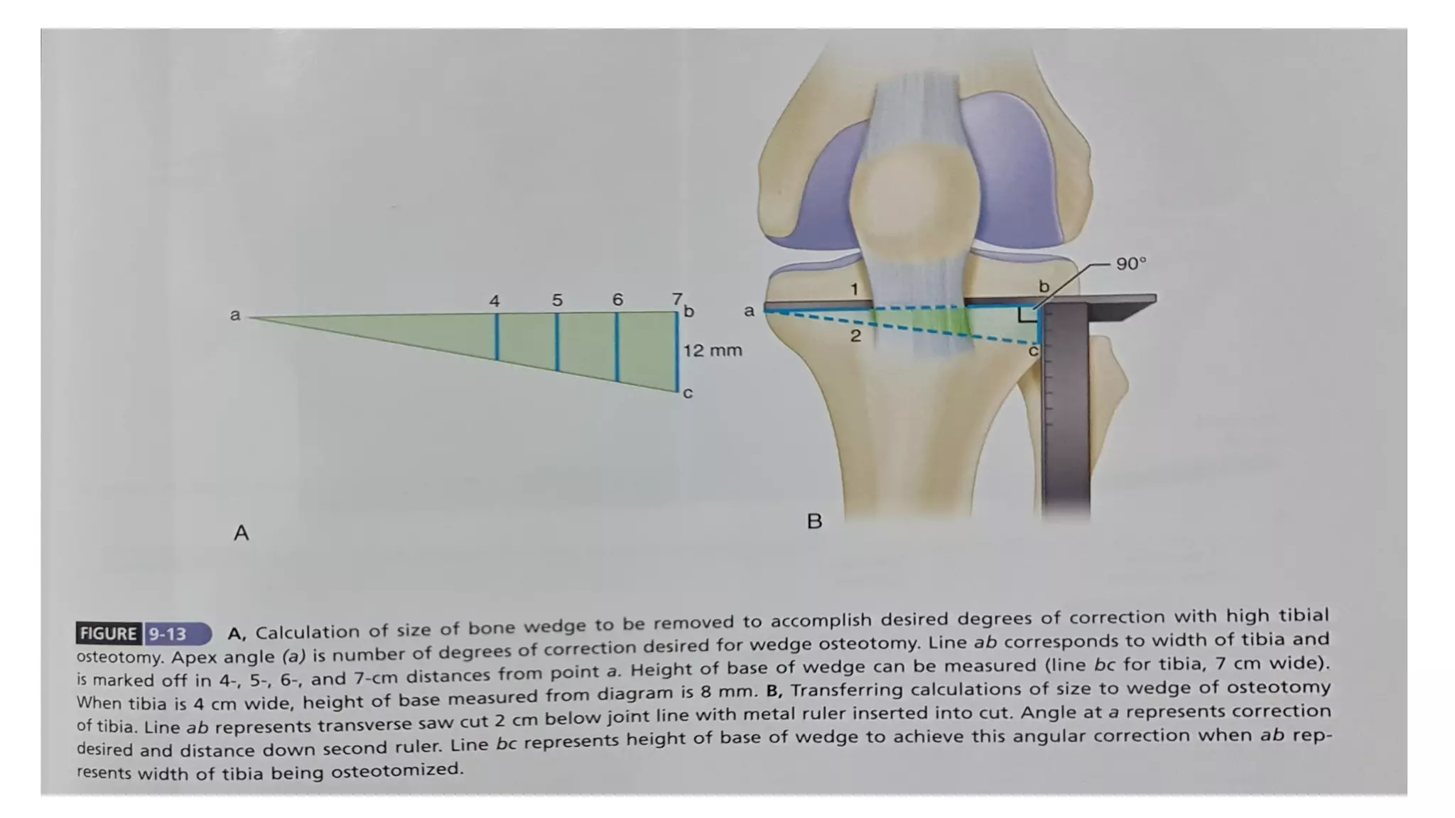 High tibial osteotomy ppt | PDF