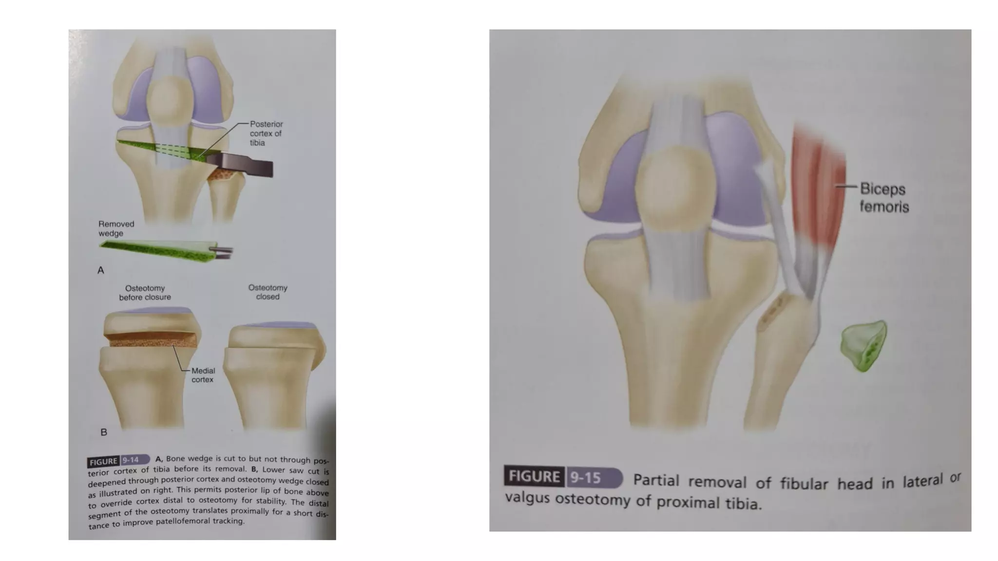 High tibial osteotomy ppt | PDF