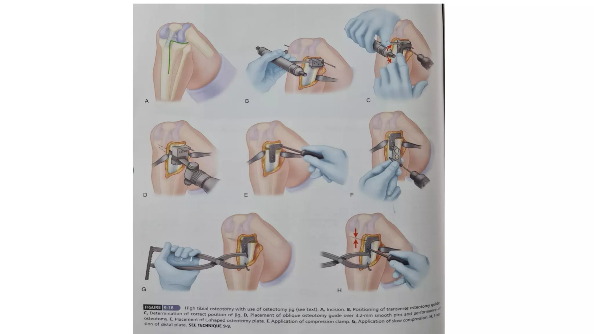 High tibial osteotomy ppt | PDF
