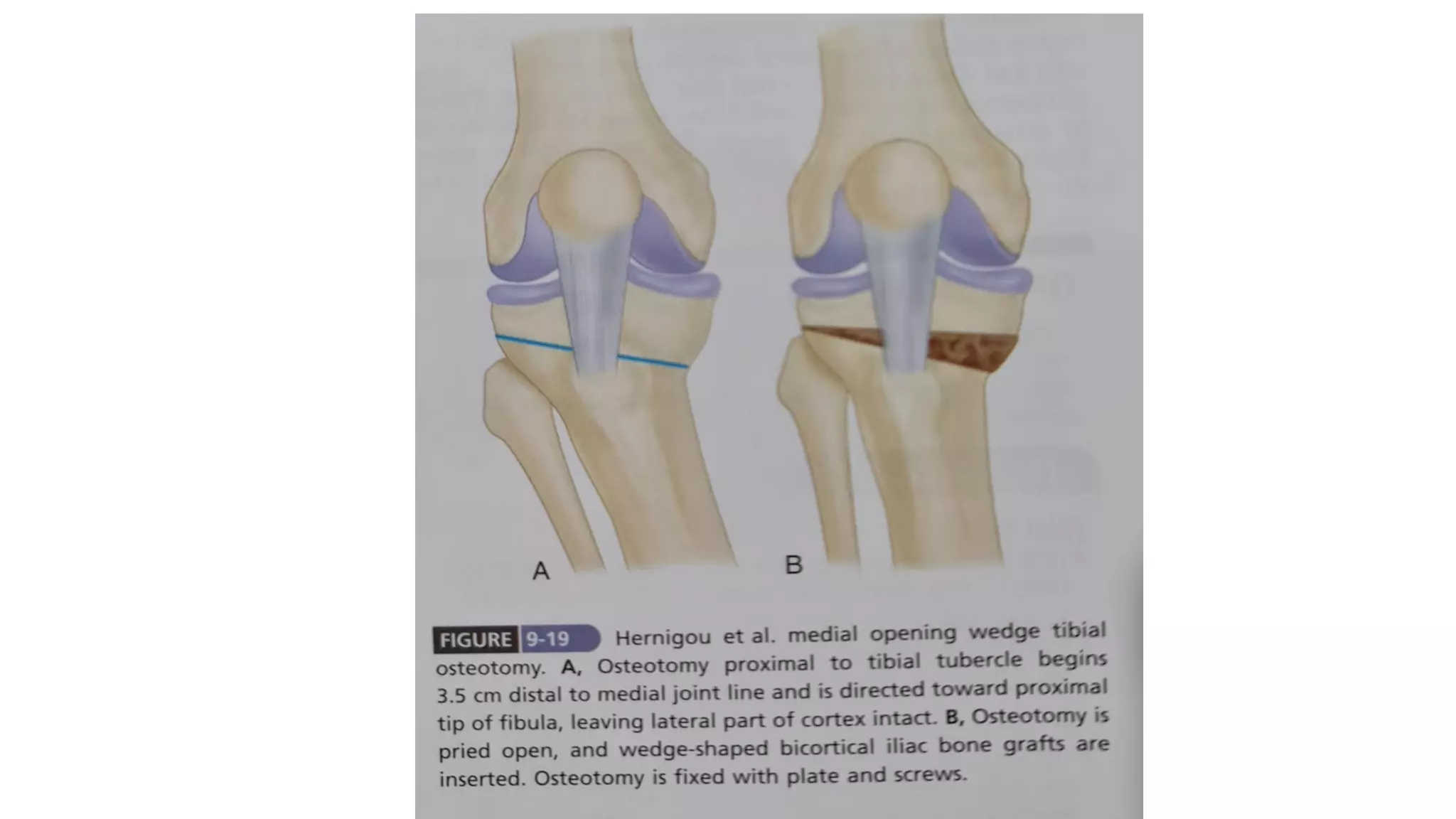 High tibial osteotomy ppt | PDF