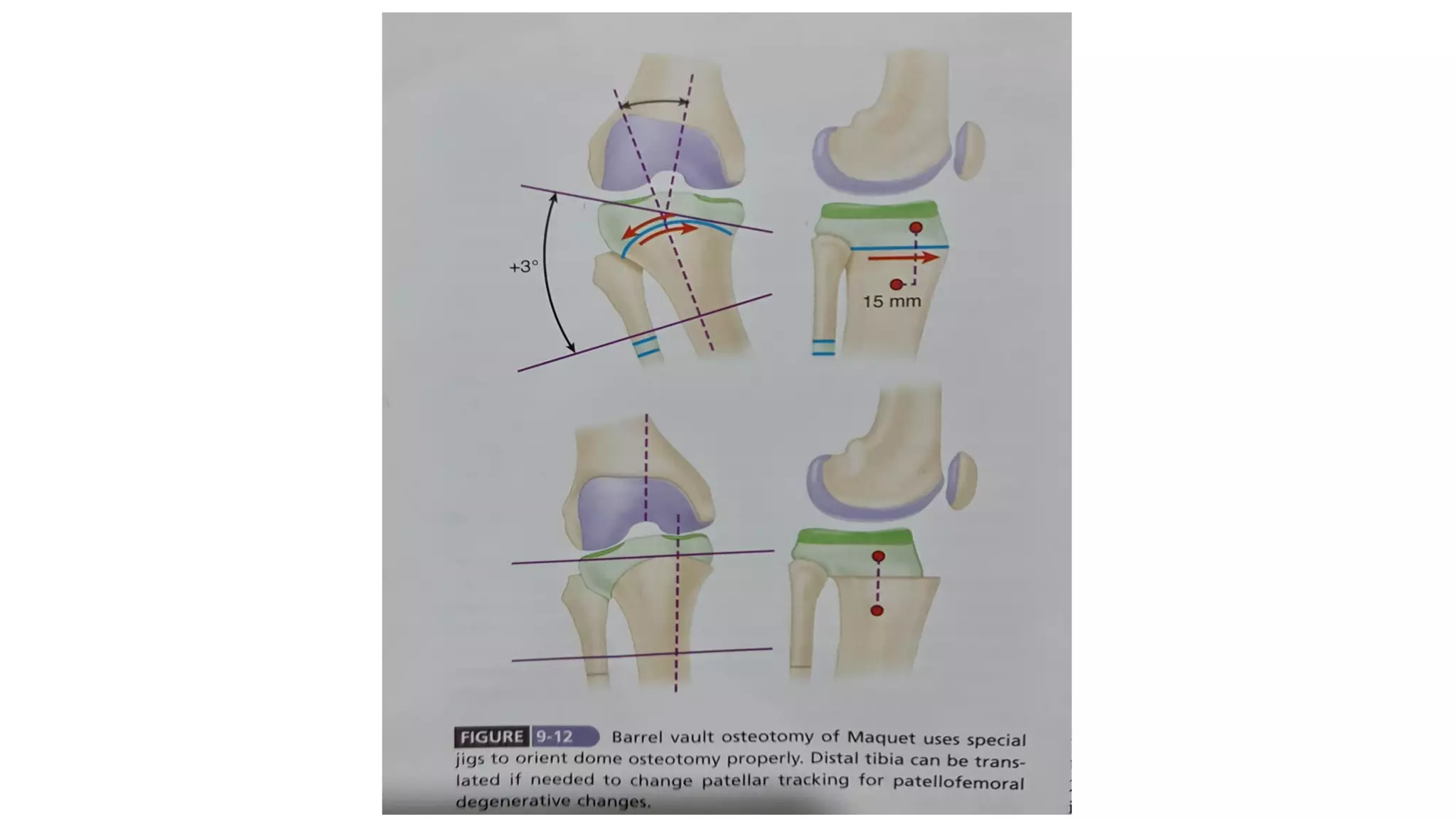 High tibial osteotomy ppt | PDF