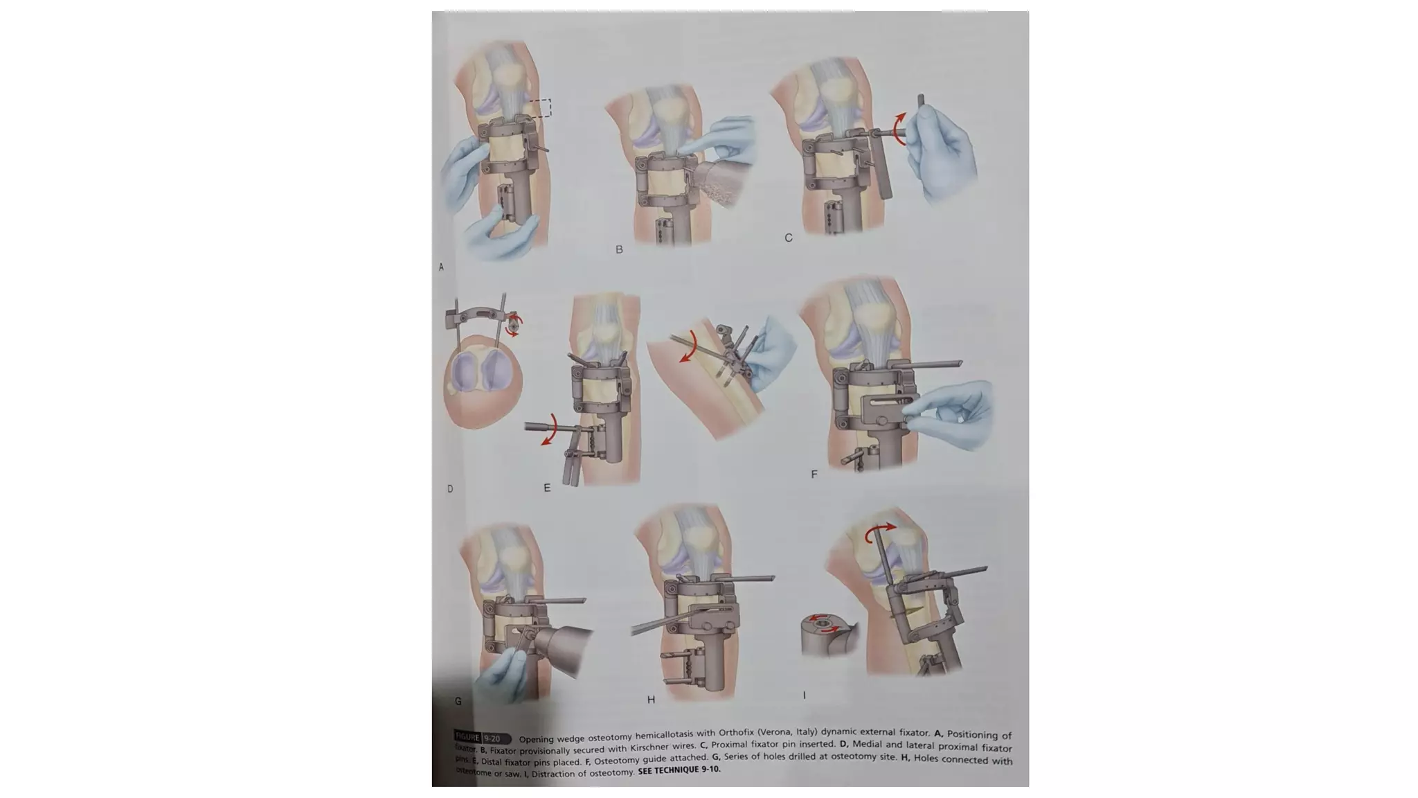 High tibial osteotomy ppt | PDF