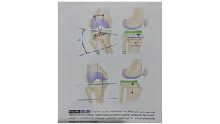 High tibial osteotomy ppt | PDF