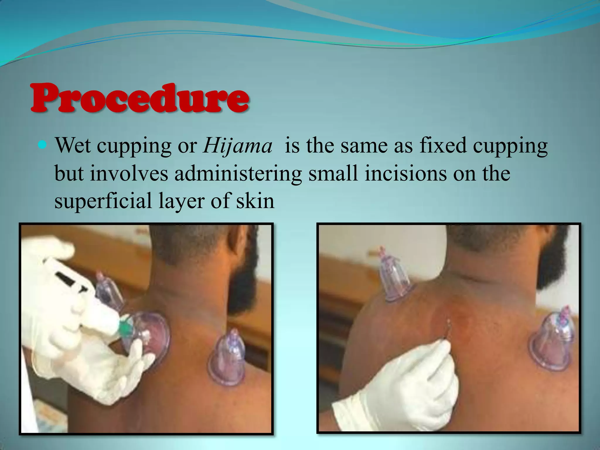 Hijama (cupping) therapy - an overview by DR MOHD SHAHID (MD) | PPTX
