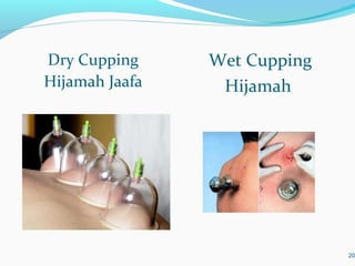 Hijamah(cupping therapy) | PPT | Islam | Religion & Spirituality