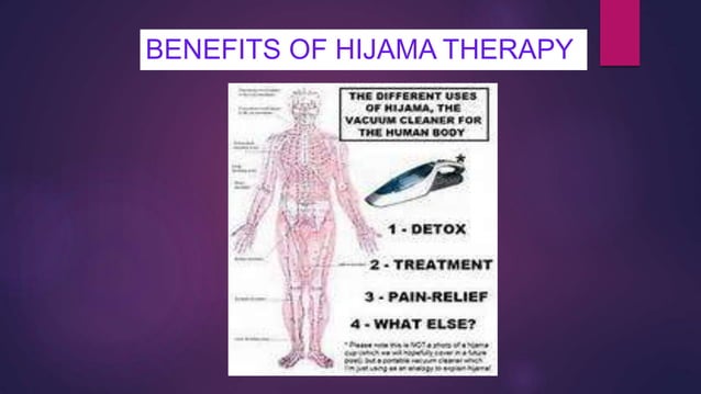 basics of hijama therapy | PPTX