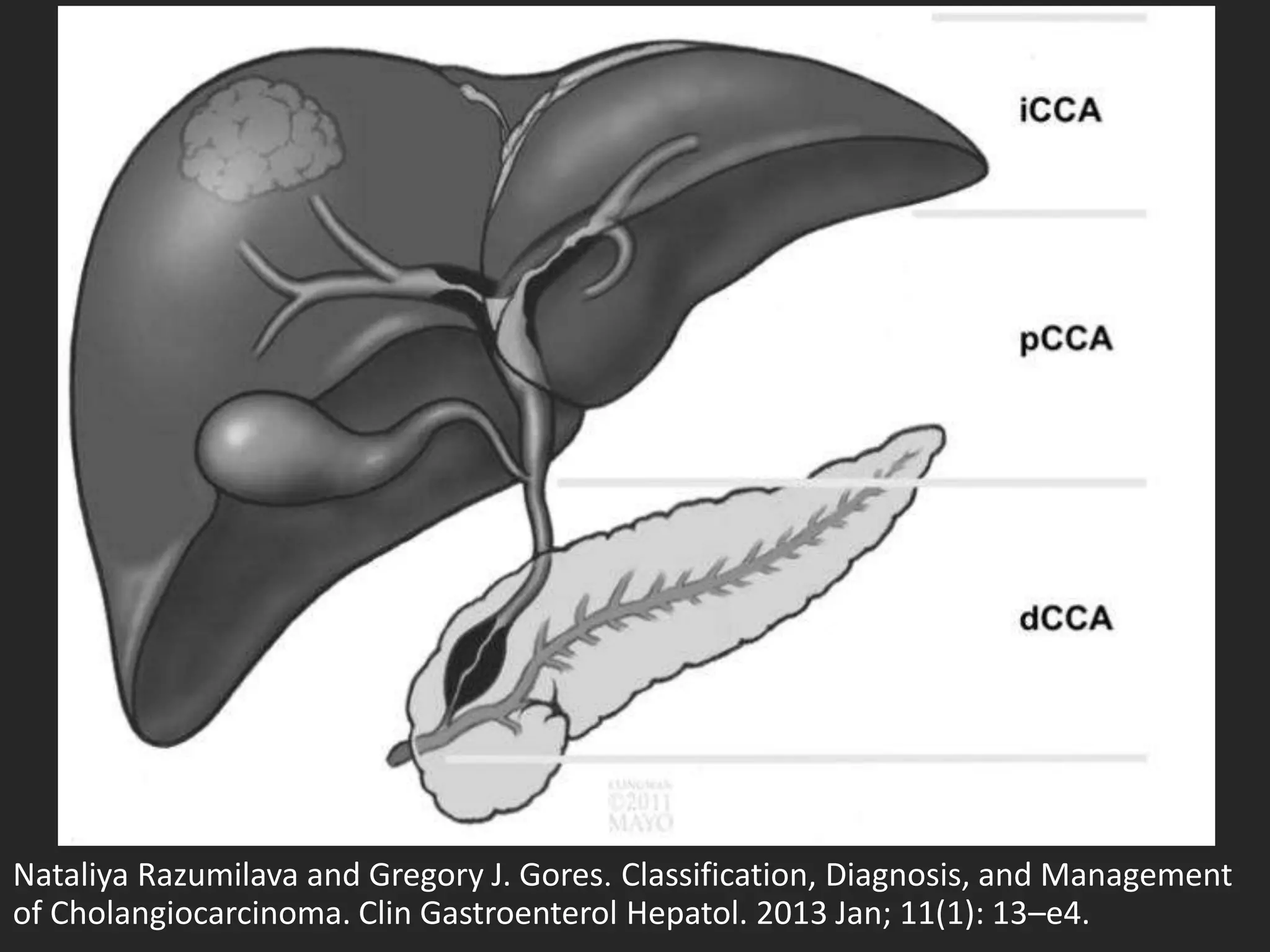 Hilar cholangiocarcinoma in my point of view | PPTX