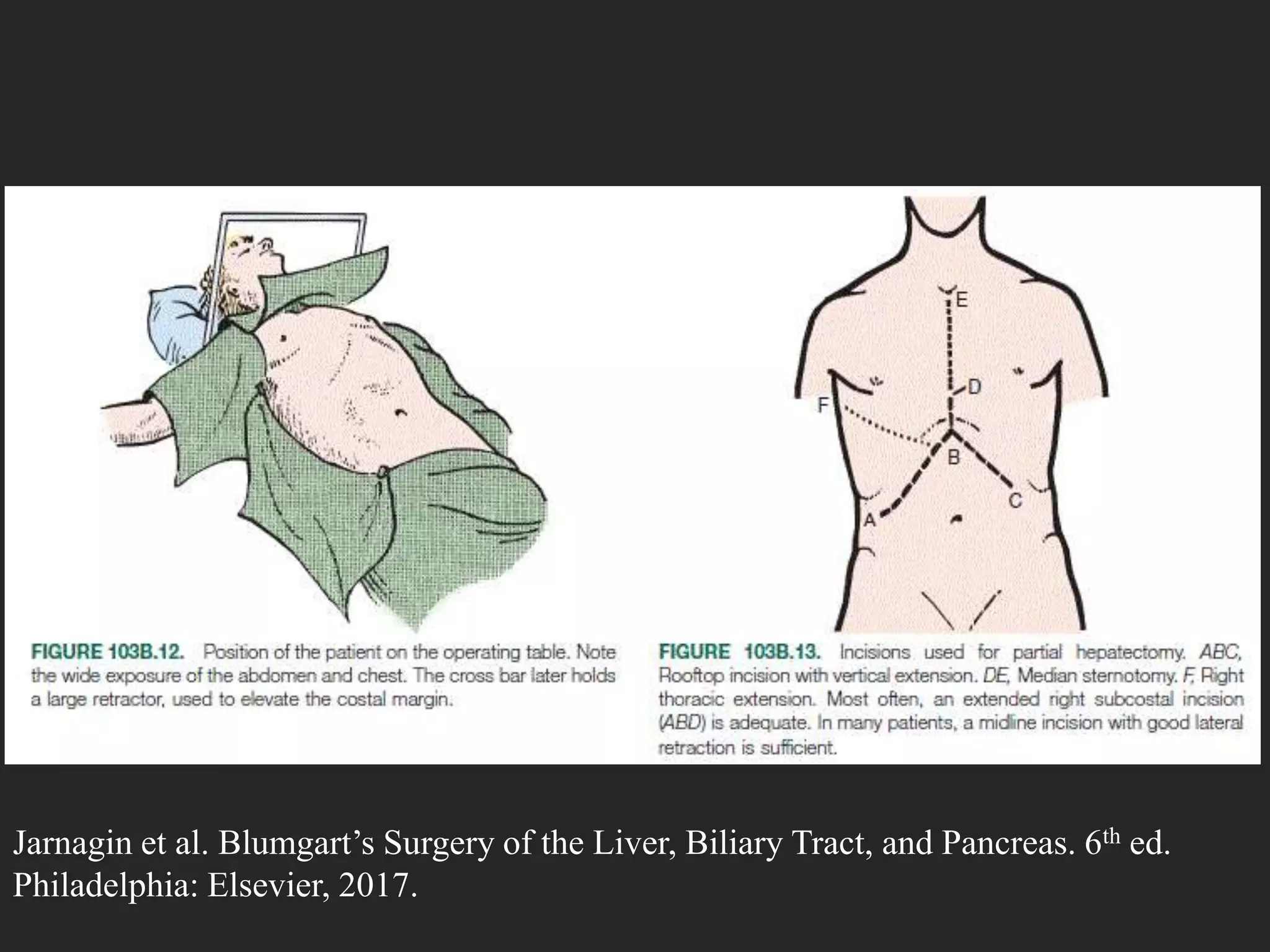 Hilar cholangiocarcinoma in my point of view | PPT