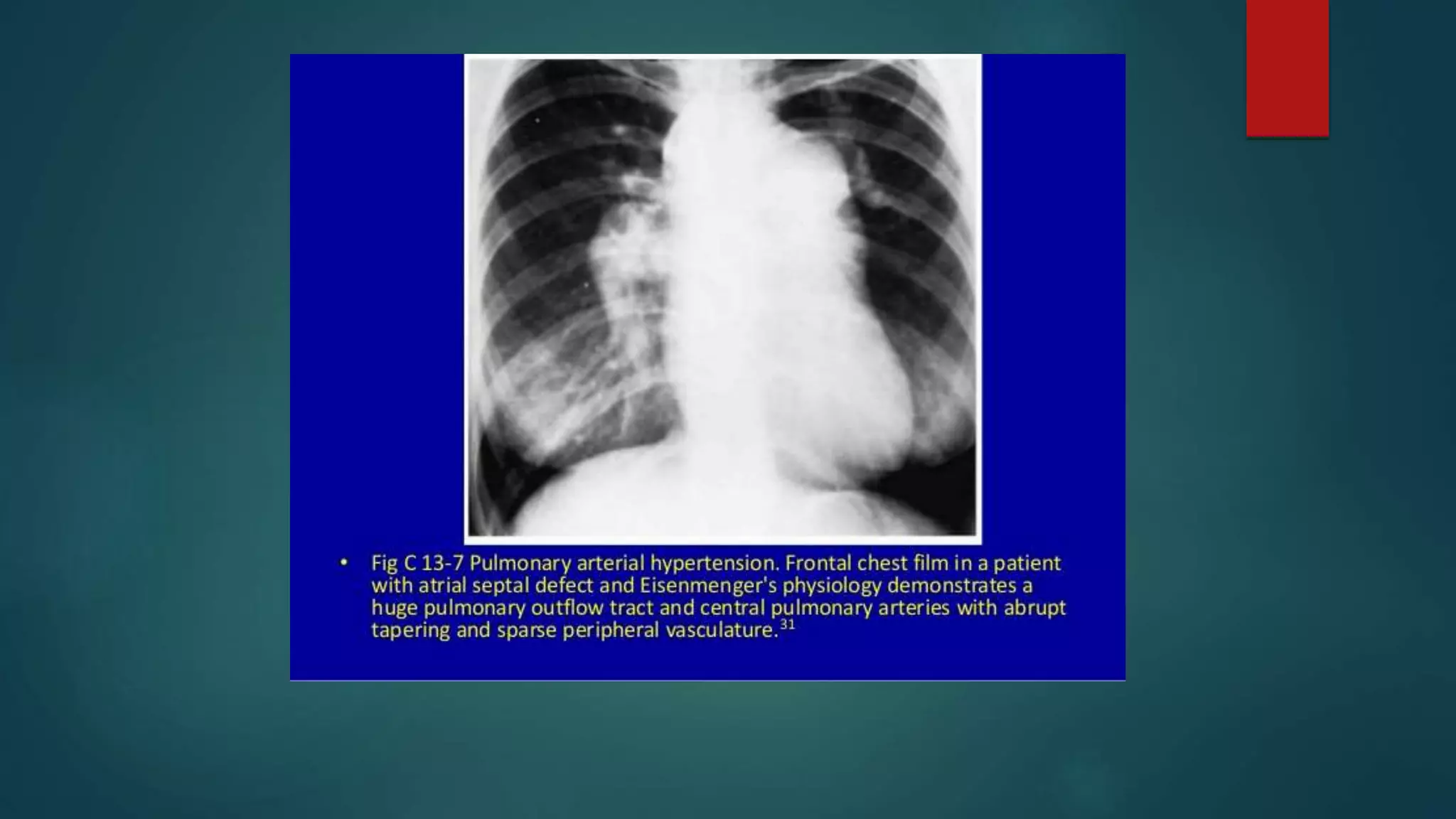Hilar enlargement radiology | PPTX