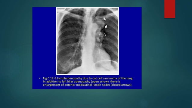 Hilar enlargement radiology | PPTX | Lung and Respiratory Health ...