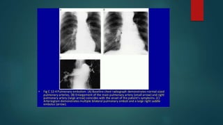 Hilar enlargement radiology | PPTX