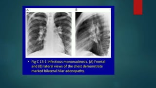 Hilar enlargement radiology | PPTX