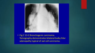 Hilar enlargement radiology | PPTX