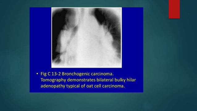 Hilar enlargement radiology | PPTX | Lung and Respiratory Health ...