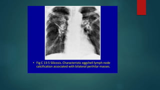 Hilar enlargement radiology | PPTX