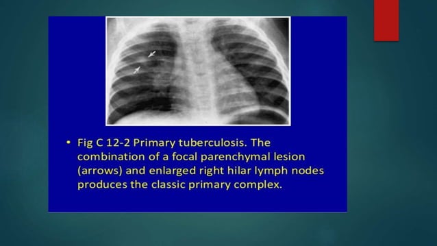 Hilar enlargement radiology | PPTX | Lung and Respiratory Health ...