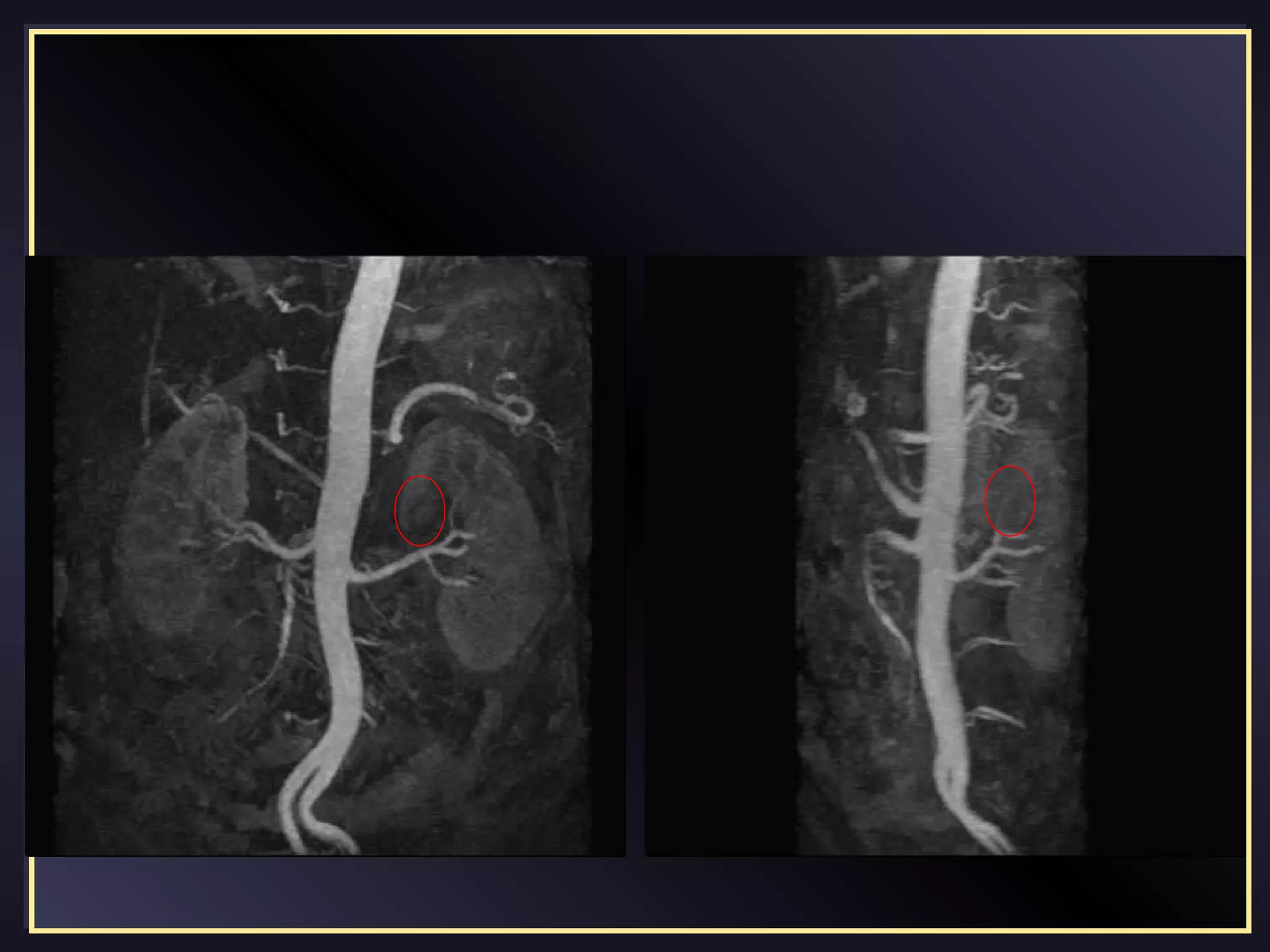 Laparoscopic Partial Nephrectomy of Hilar Tumors with Cold Ischemia | PPT