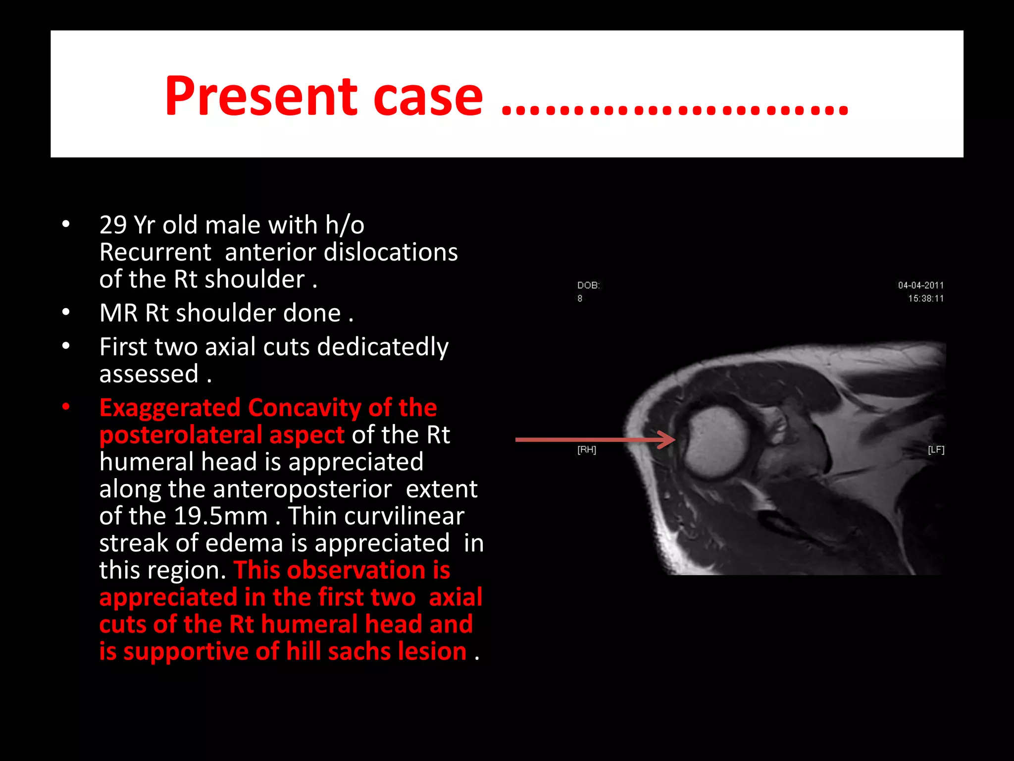Hill sachs | PPT